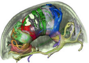 Logiciel d'analyse - MeVis Medical Solutions AG - de planification ...