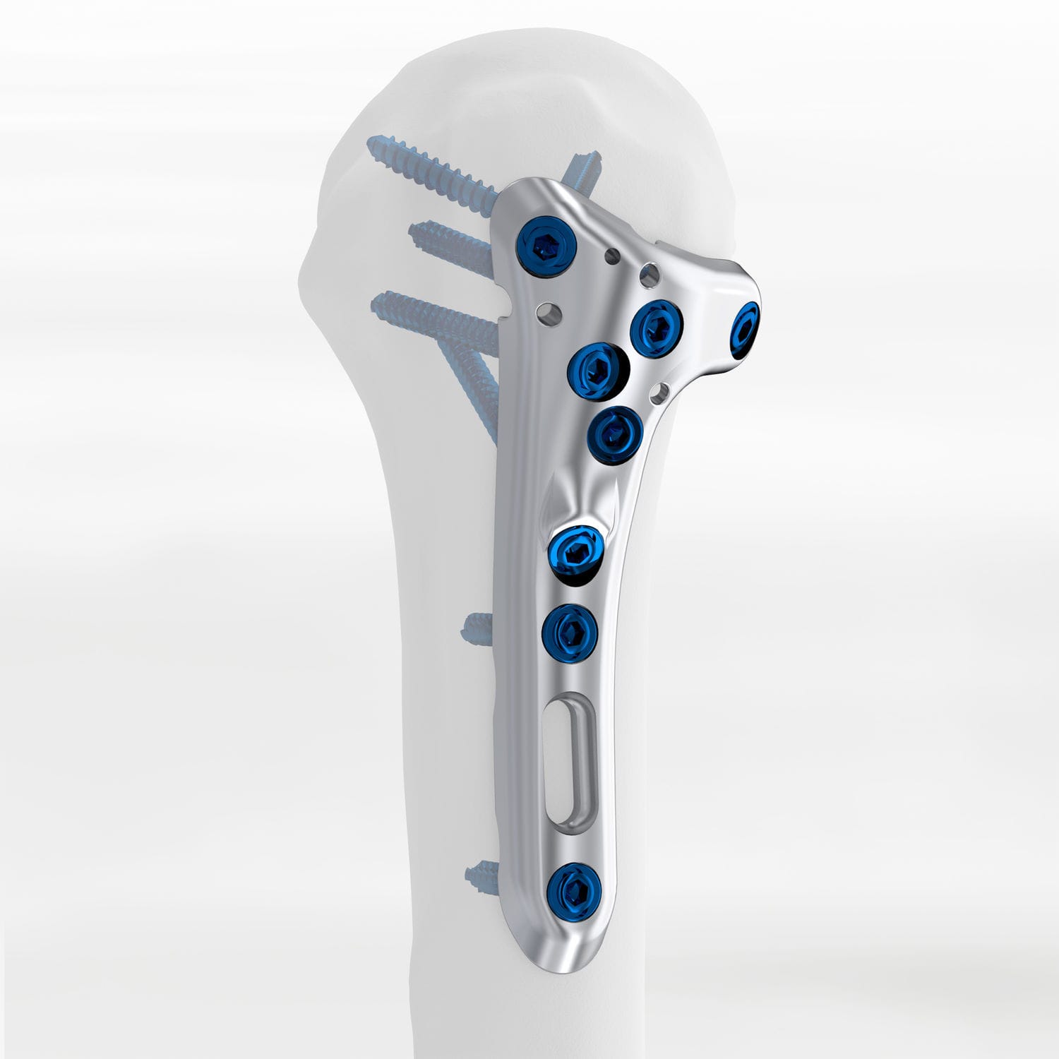 Plaque de compression d'humérus - PGR - 135.11XX - Intrauma - proximale ...