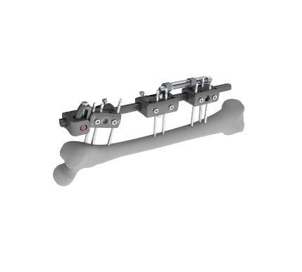 Fixateur externe de tibia - FIXUS88 mini - Fixus - de fémur / d'humérus ...