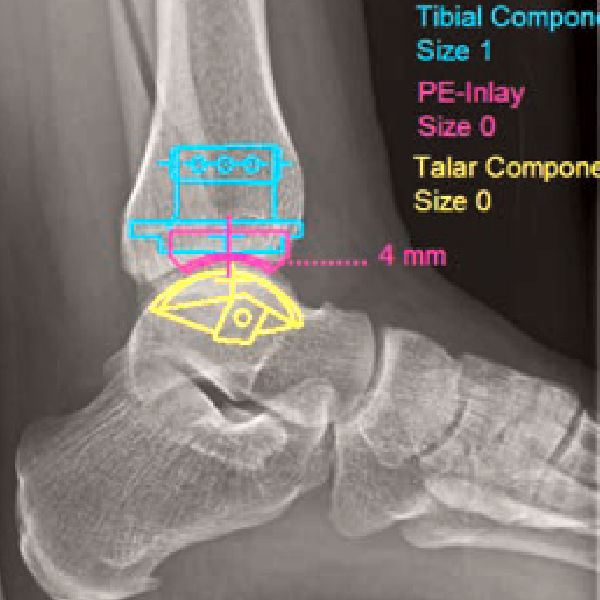 Logiciel de planification - mediCAD Hectec GmbH - orthopédique / de ...