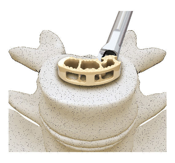 Cage intersomatique lombaire - Dica - Shanghai Sanyou Medical - voie ...