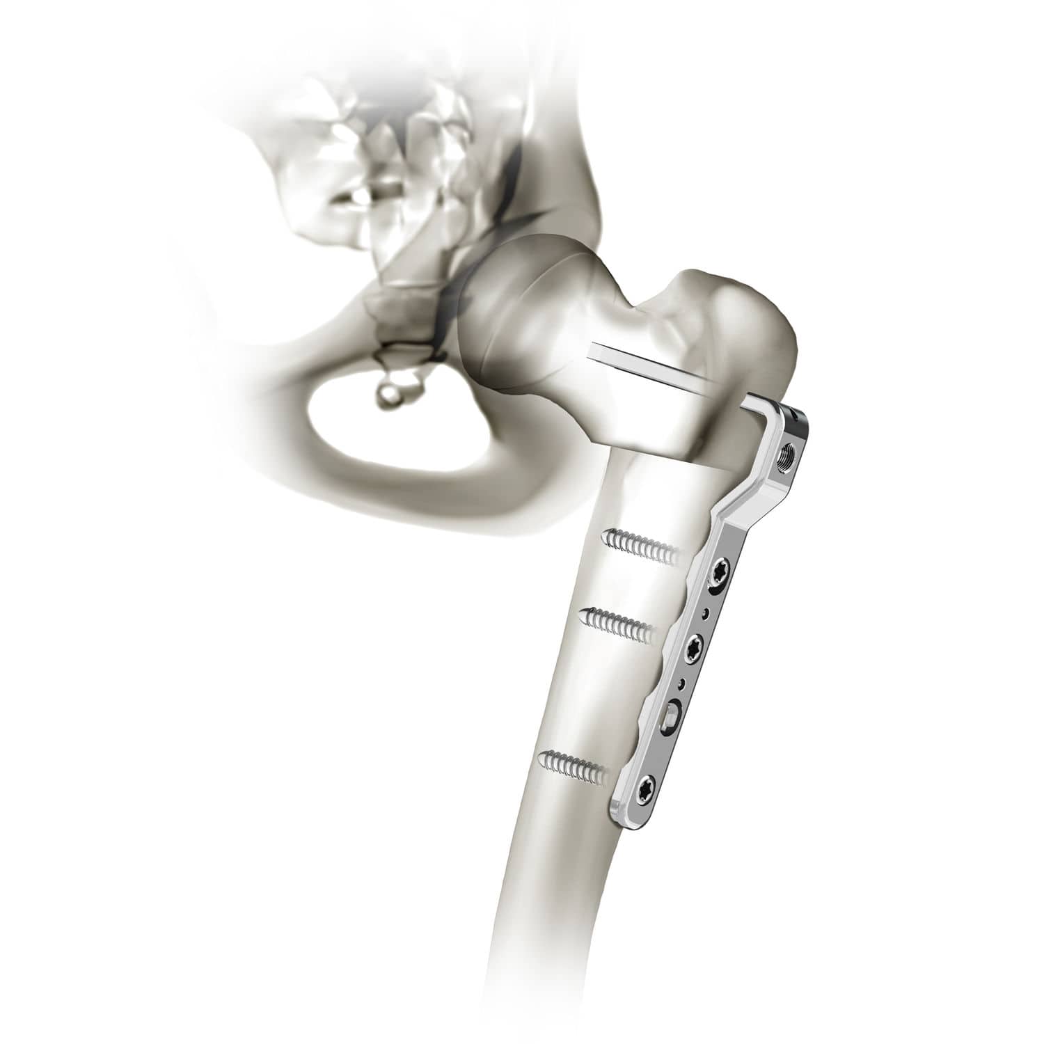 Plaque de compression de fémur - 00-1200-2000 - OrthoPediatrics ...