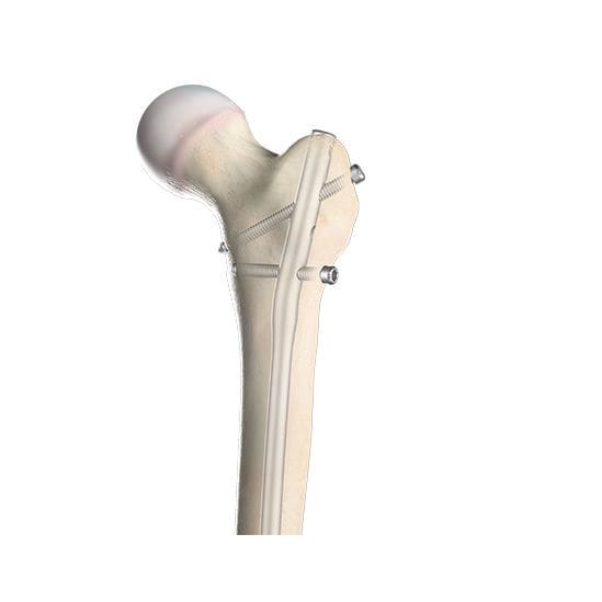 Clou intramédullaire fémoral - 00-1501-0720 - OrthoPediatrics ...