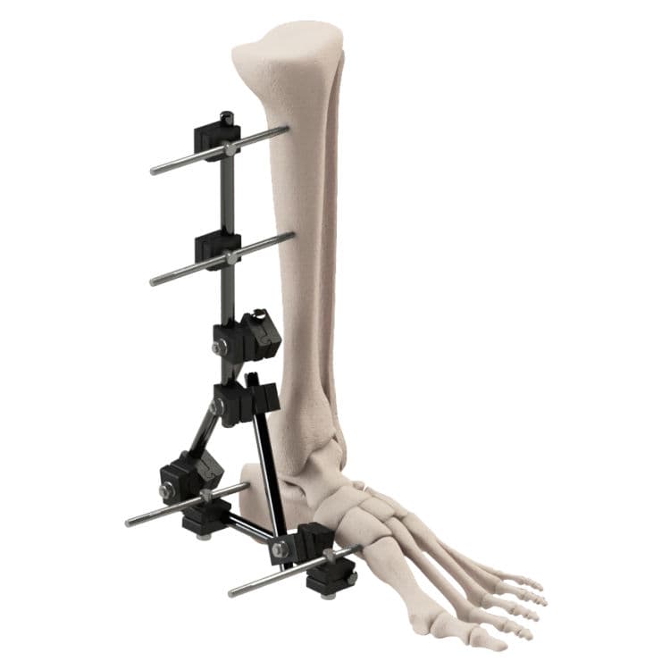 Fixateur externe de cheville - CCS 2 T-T - Selaz - tubulaire