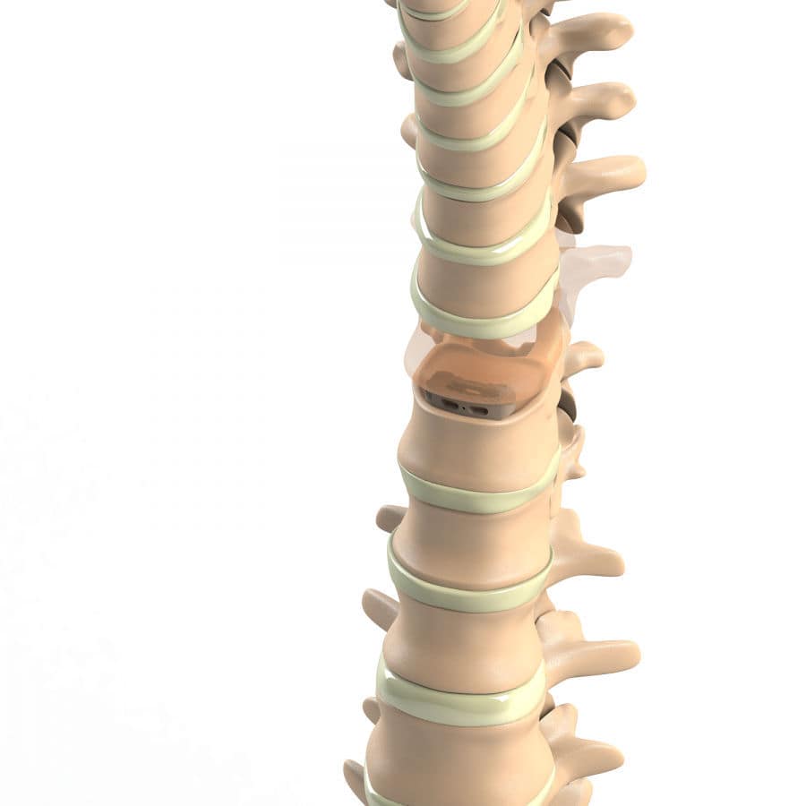 Cage intersomatique lombaire / voie transforaminale / en PEEK - TLIF ...