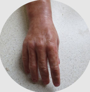 Épithèse de main - myo-electric - Northern Prosthetics - adulte