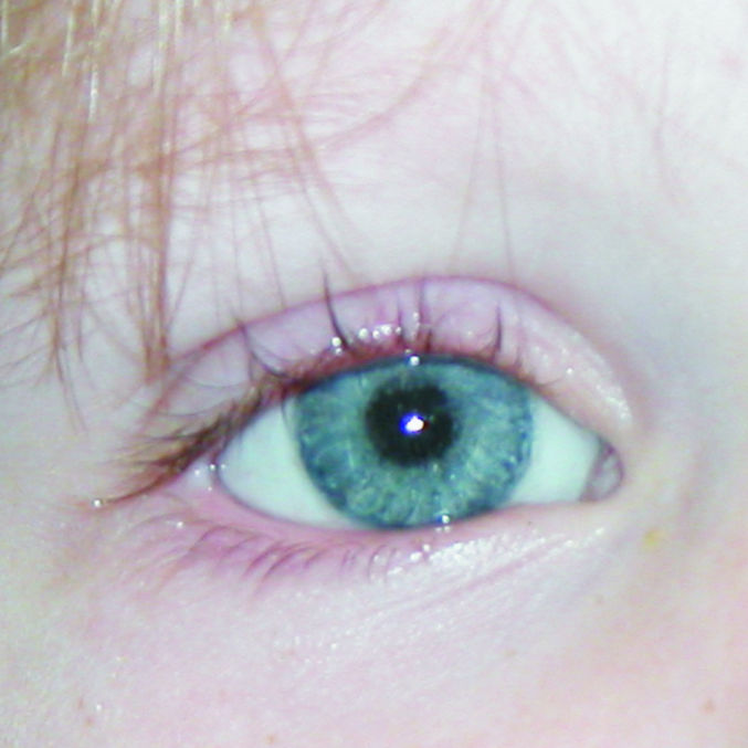 Épithèse oculaire - Prosthetic Illusions - pédiatrique