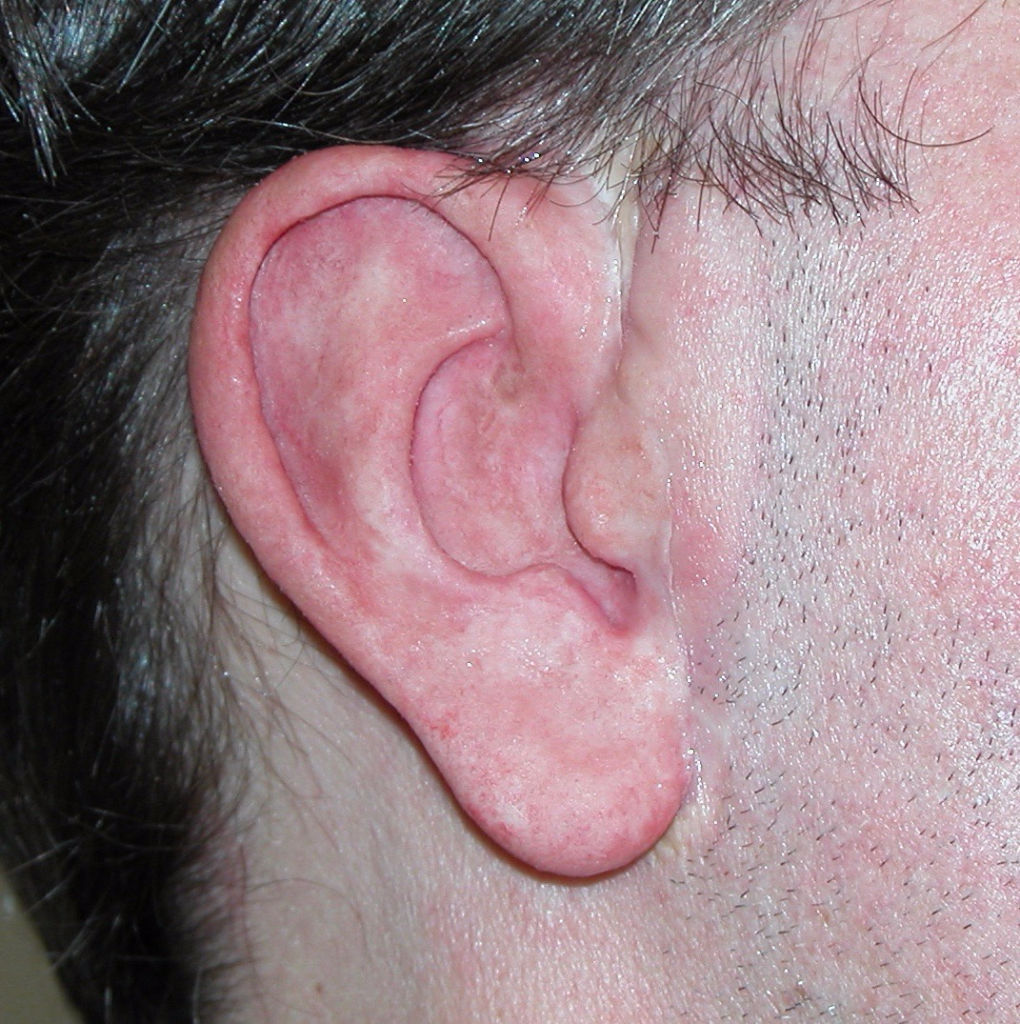 Épithèse auriculaire - Prosthetic Illusions - adulte