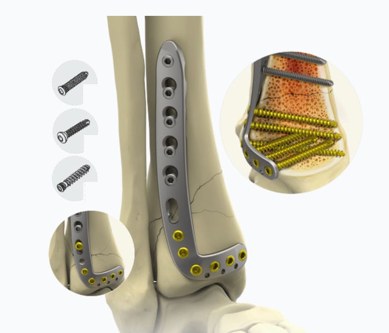 Plaque de compression de tibia - 10132 series - Zimed Medical - distale ...