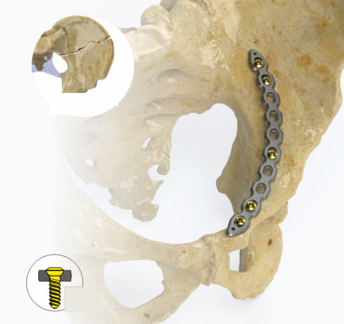 Plaque de compression de petit fragment osseux - 1932 series - Zimed ...