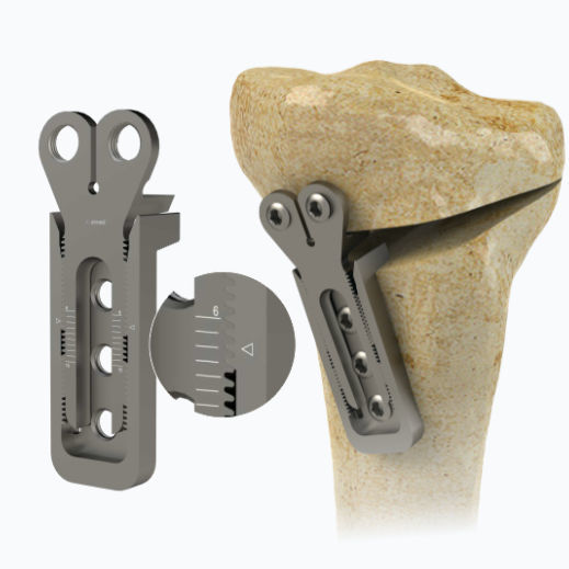 Plaque d'ostéotomie de tibia - 1972 Series - Zimed Medical - verouillée