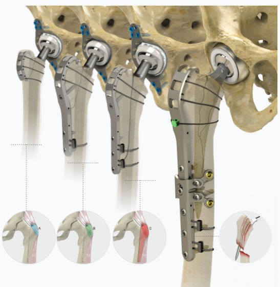 Plaque de compression de fémur - Zimed Medical