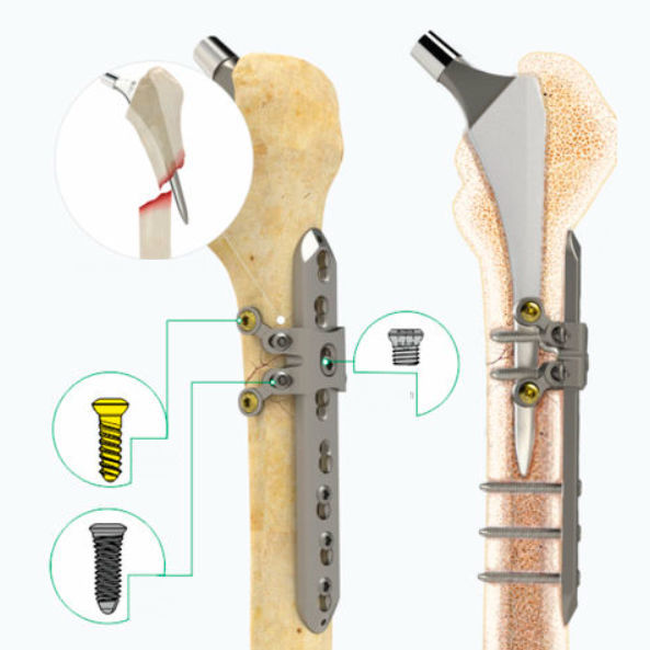 Plaque de compression de tibia - 2912 Series - Zimed Medical - verouillée