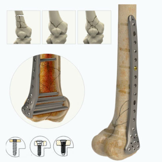 Plaque de compression fémorale - Zimed Medical - distale / latérale ...