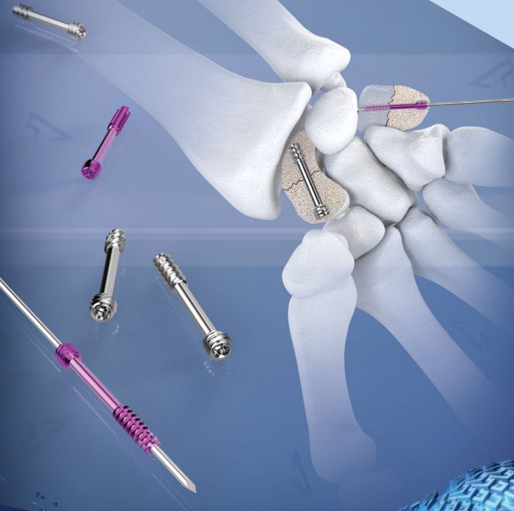 Vis de compression à os de métacarpe - AGOMED Medizin-Technik - de tête ...