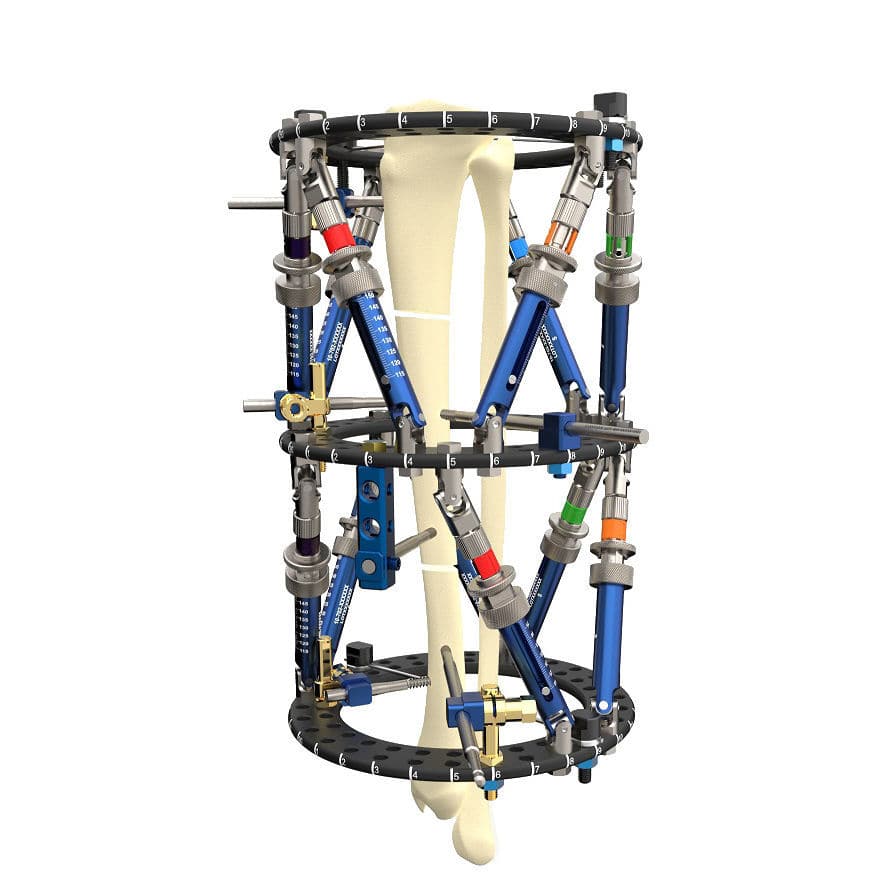 Fixateur externe de tibia - Smart Correction® - WishBone Medical - de ...