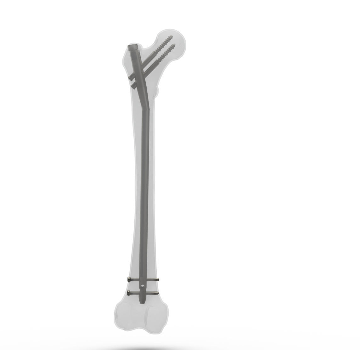 Clou intramédullaire fémoral - FN2 series - TASARIMMED - fixation ...