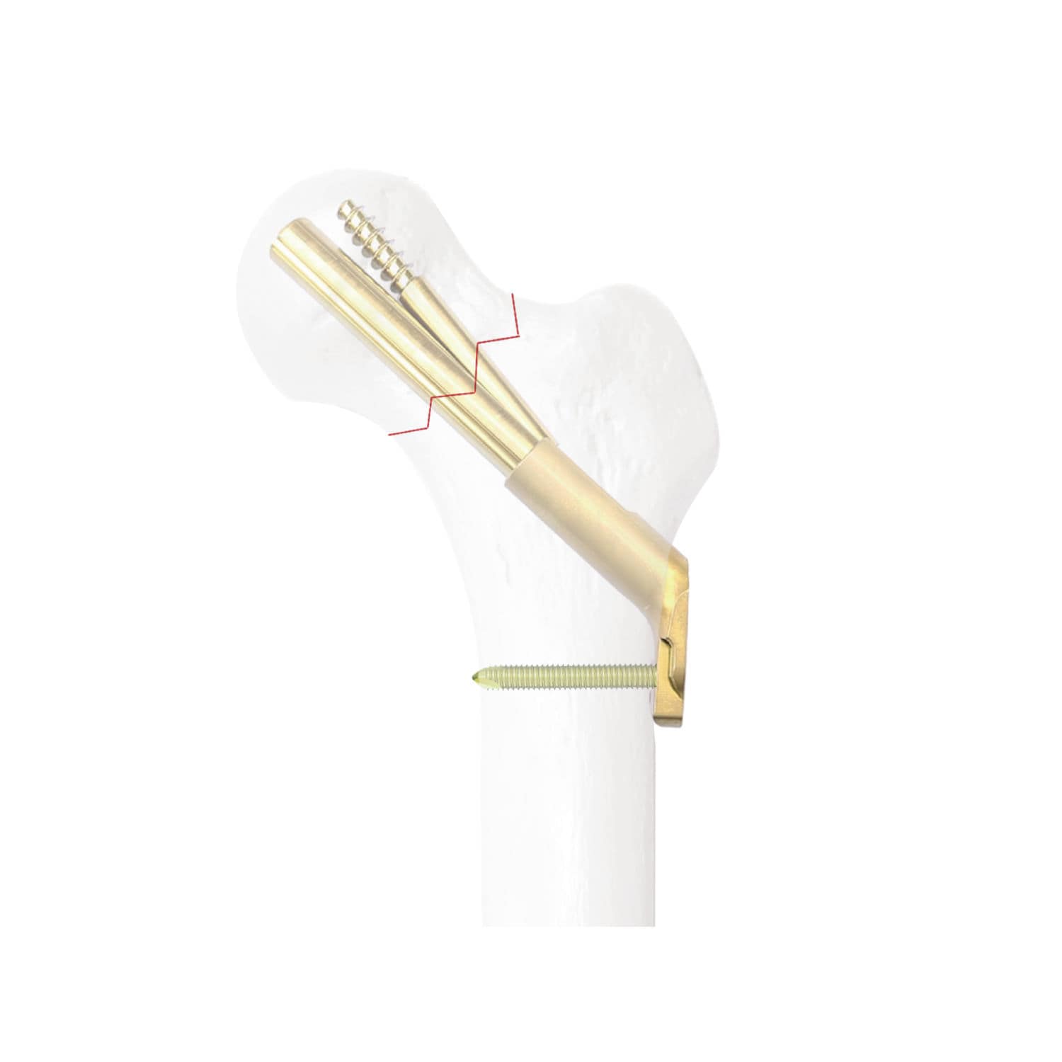 Plaque de compression de tête fémorale - 33506 - Kangli Medical ...