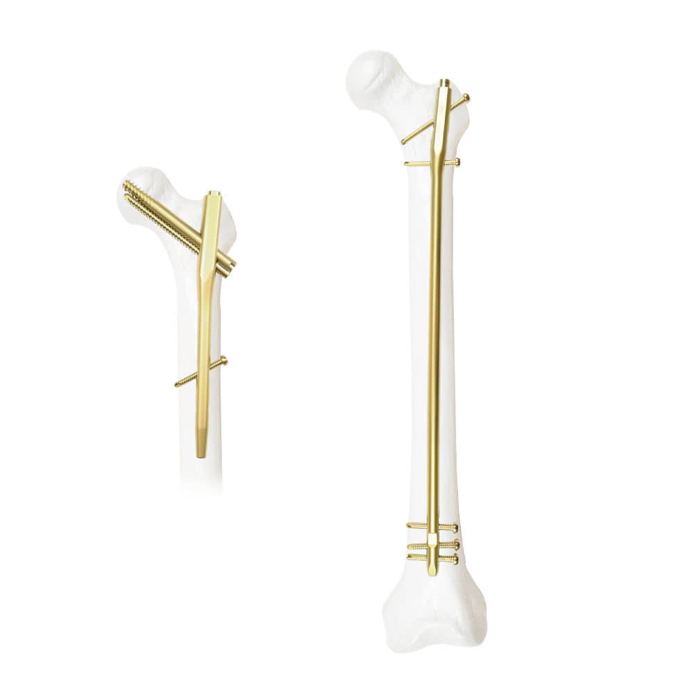 Clou intramédullaire fémoral - KTO - Kangli Medical - de trochanter ...