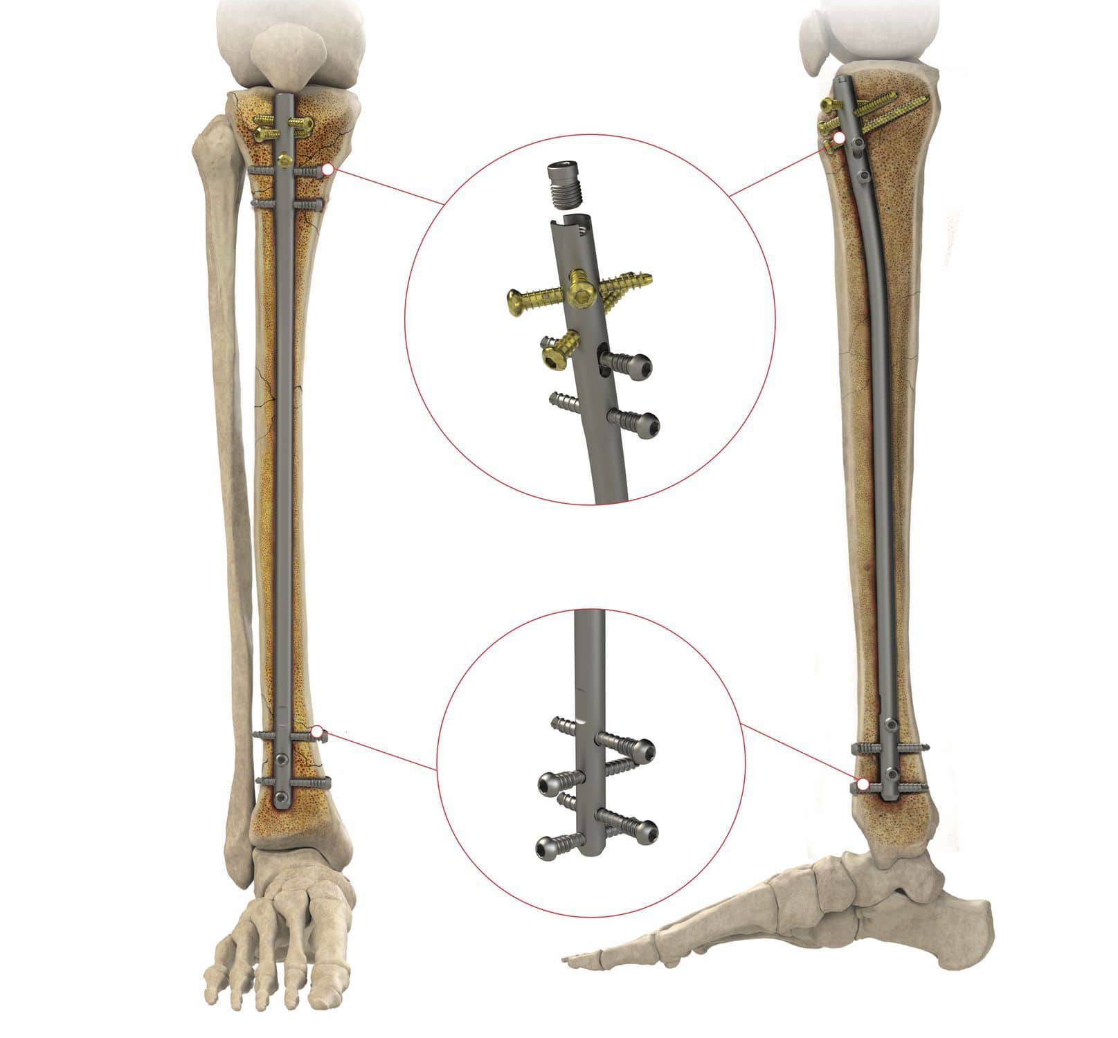 Clou intramédullaire de tibia - AS.ATN.401 - Ases Orthopedics ...