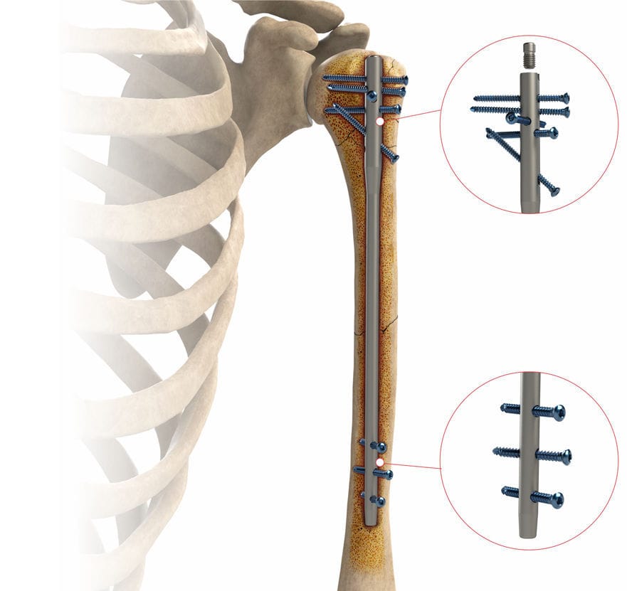 Clou intramédullaire huméral - AS.HUM.402 - Ases Orthopedics - fixation ...
