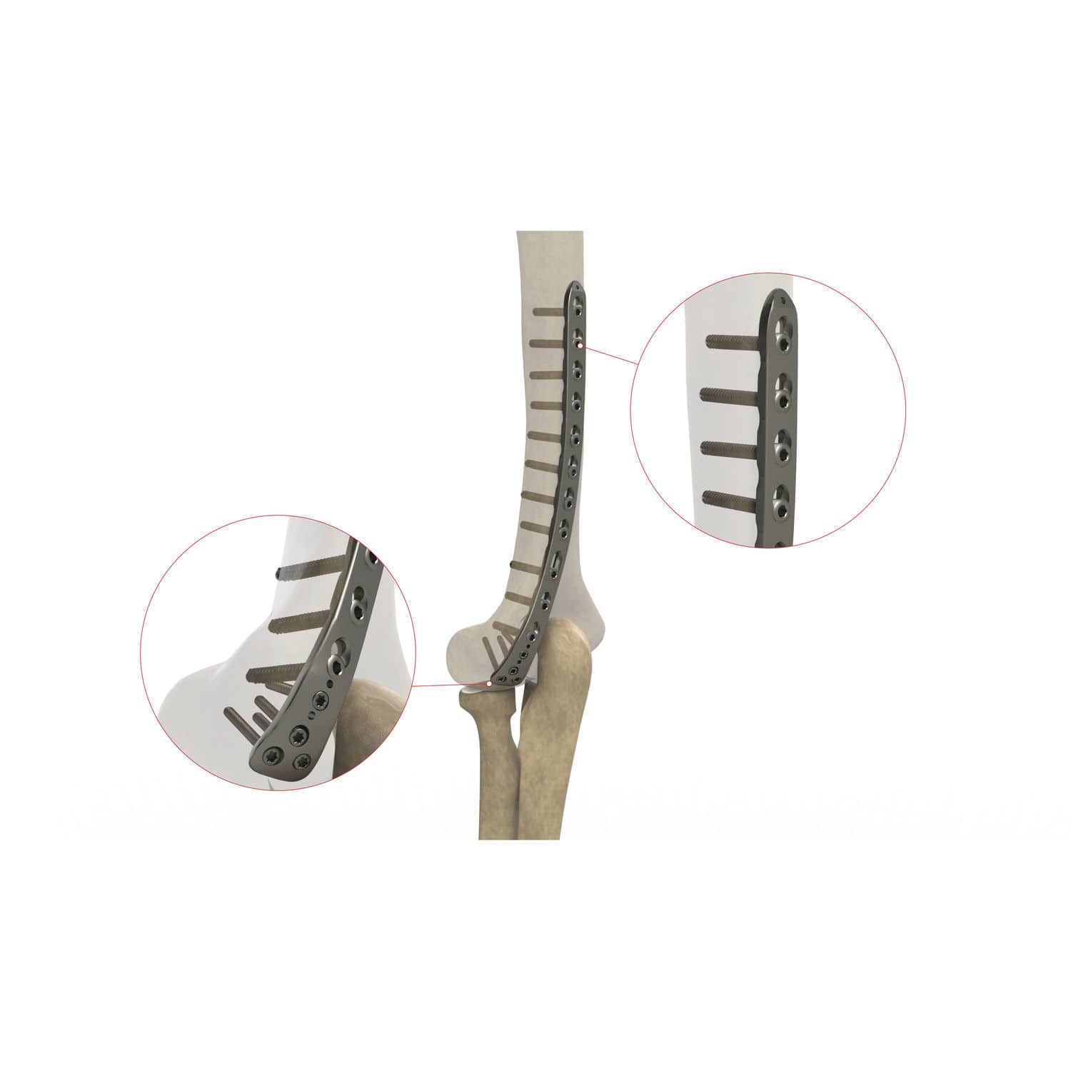 Plaque de compression d'humérus - AS.E.023 - Ases Orthopedics - distale ...