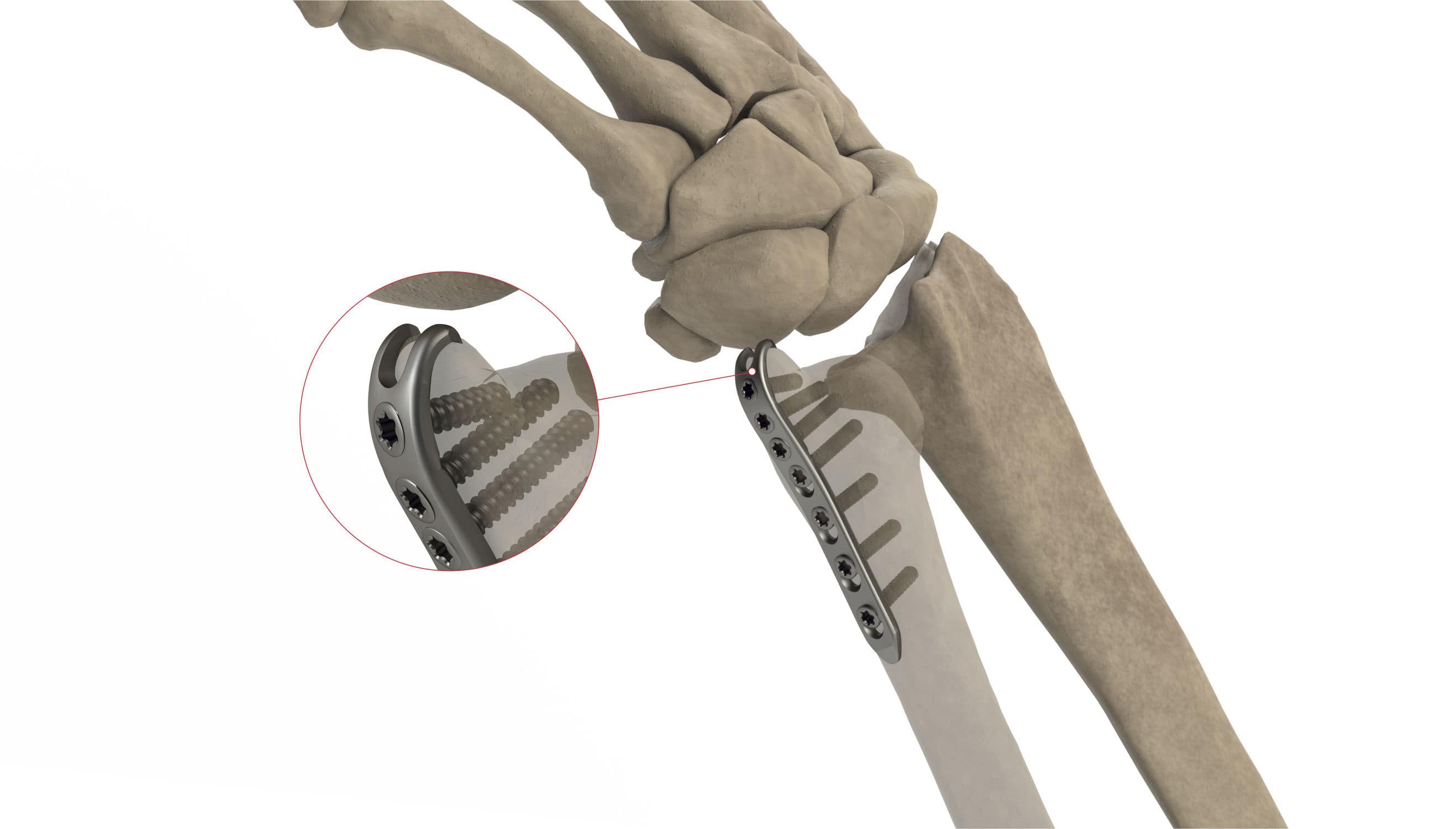 Plaque de compression d'ulna - Styloid LP - Ases Orthopedics - verouillée