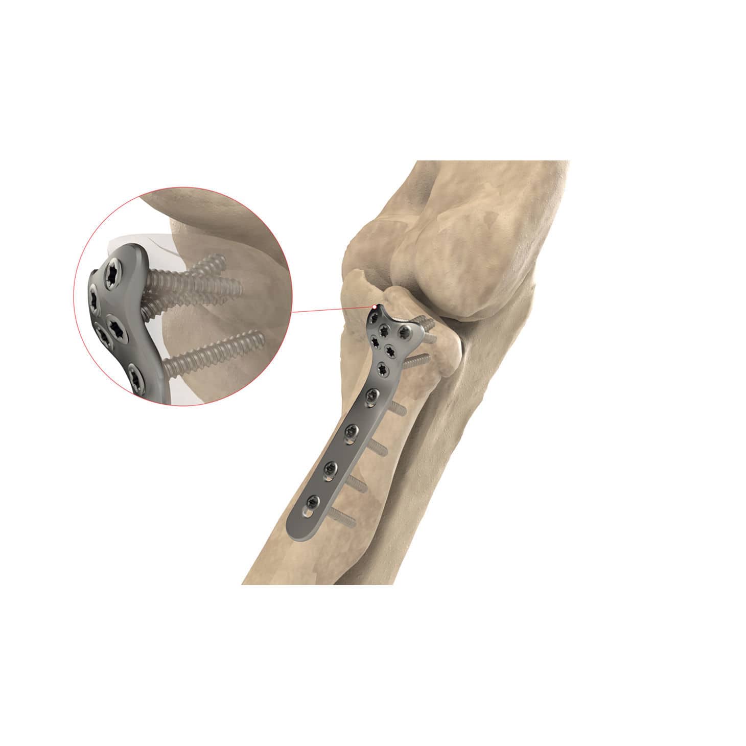 Plaque de compression de radius - Ases Orthopedics - verouillée