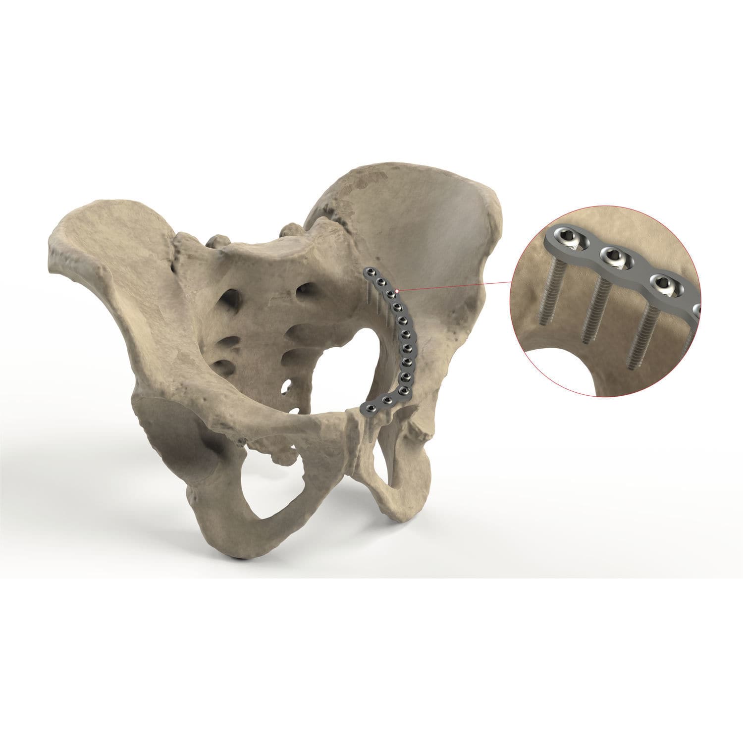 Plaque de compression pelvienne - Ases Orthopedics