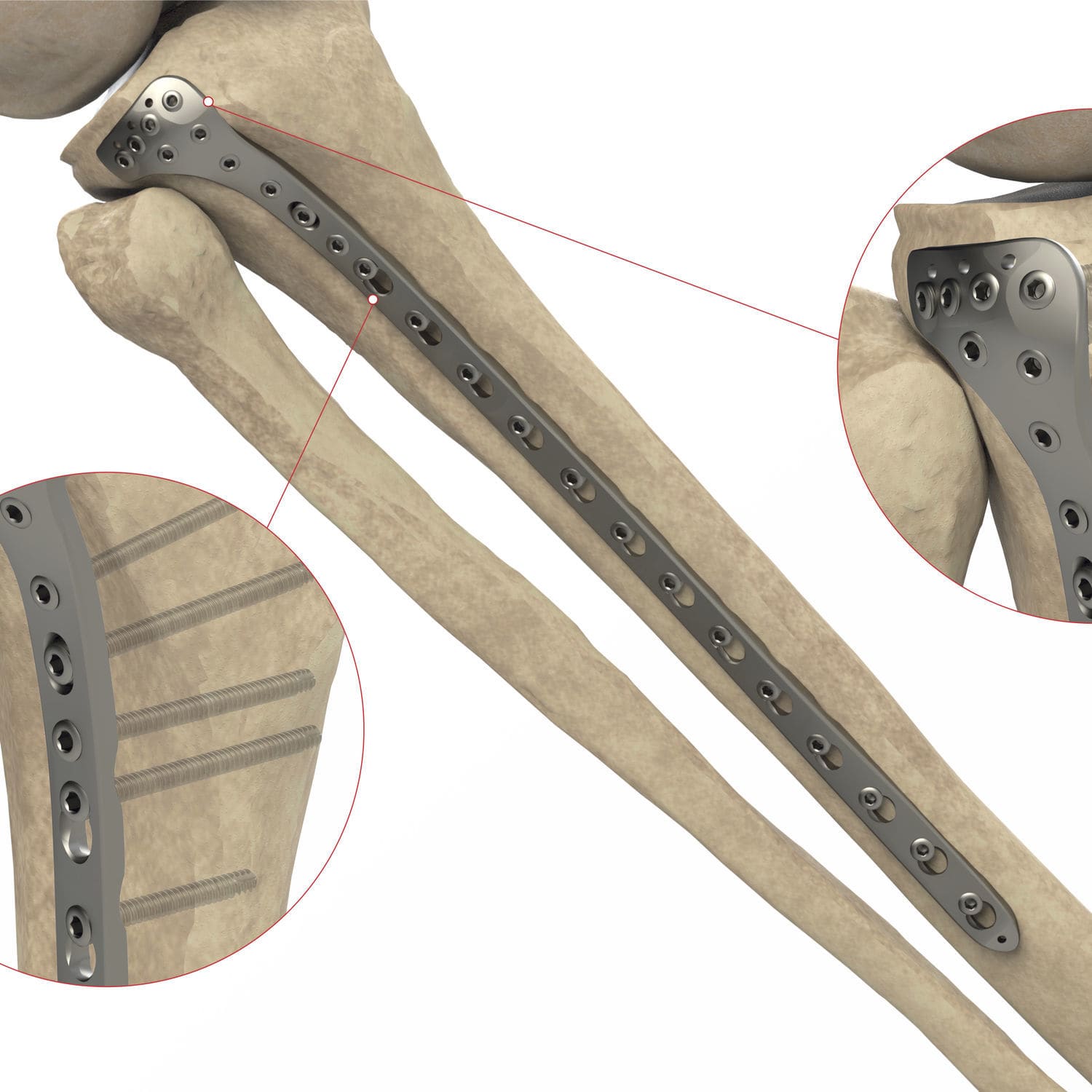 Plaque de compression de tibia - Ases Orthopedics - proximale ...