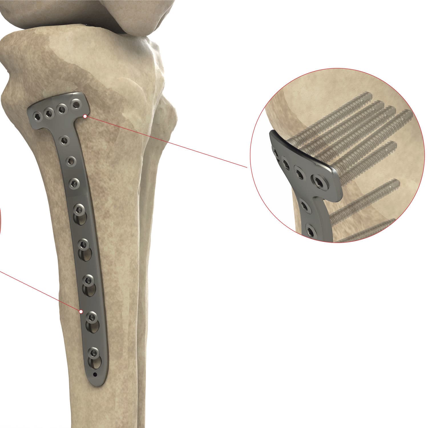 Plaque de compression de tibia - Ases Orthopedics - proximale / médiale ...