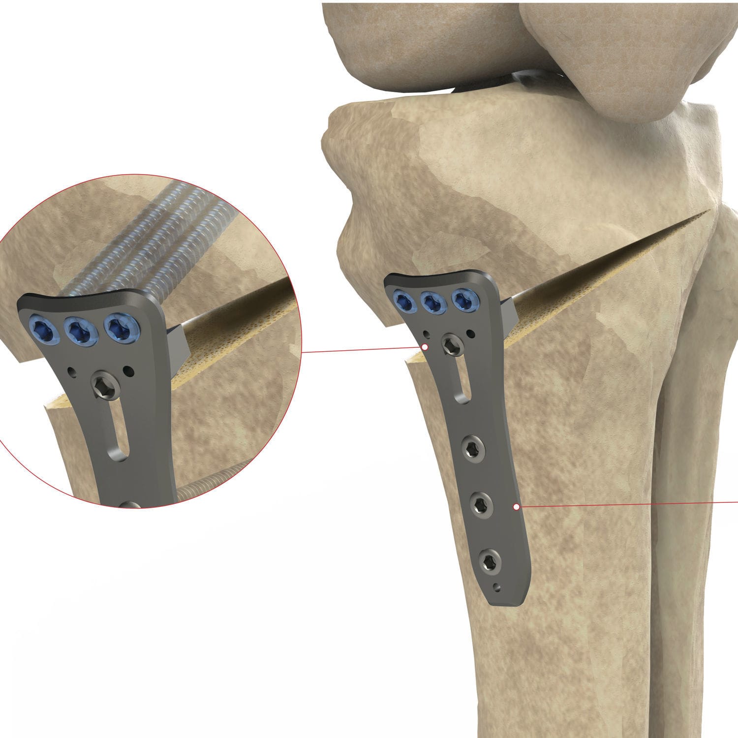 Plaque de compression de tibia - Ases Orthopedics - verouillée