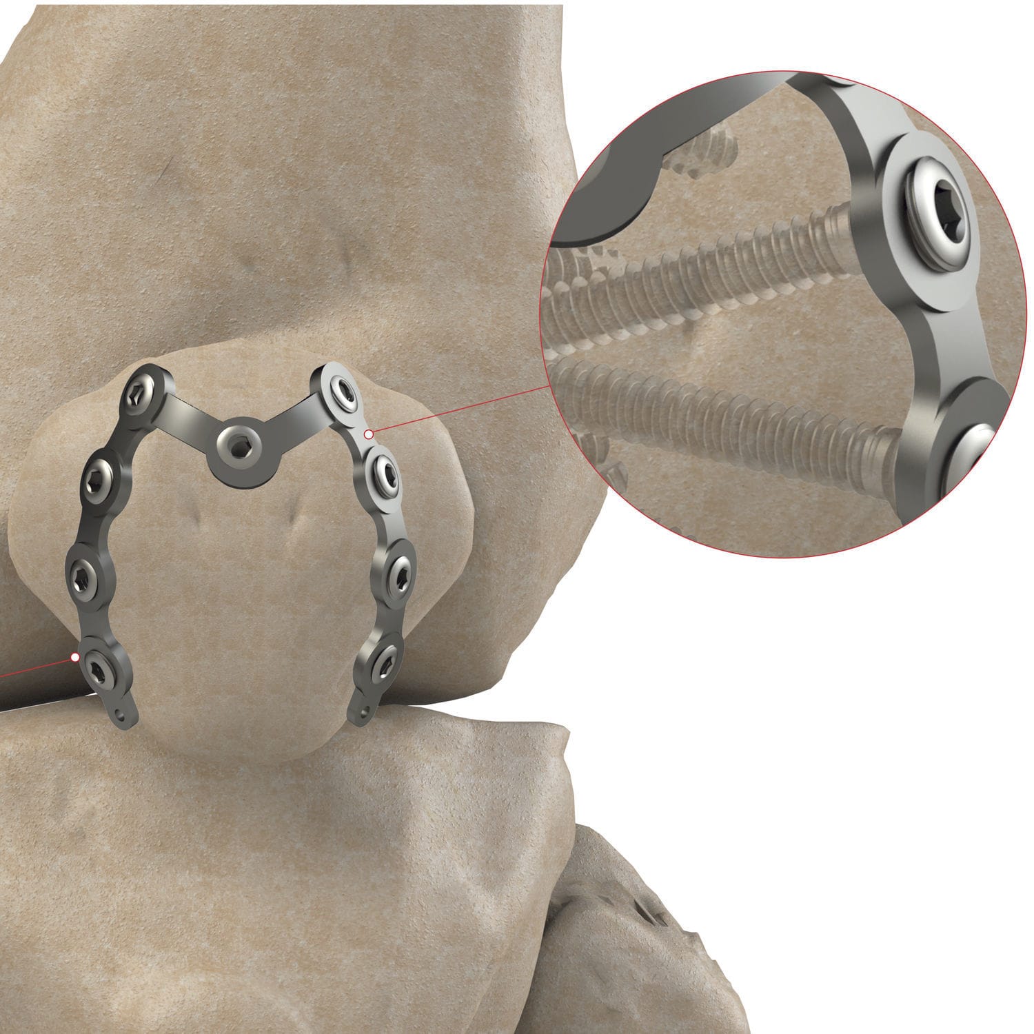 Plaque de compression de rotule - Ases Orthopedics - verouillée