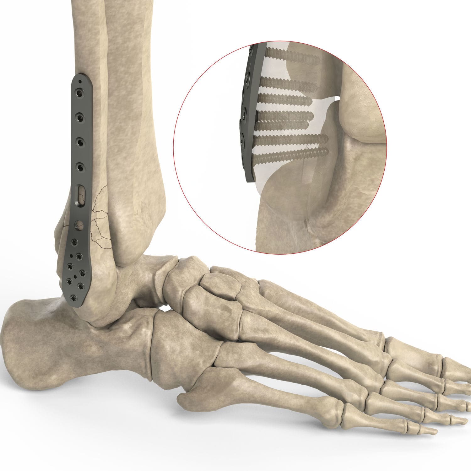 Plaque de compression de fibula - Ases Orthopedics - distale / latérale ...