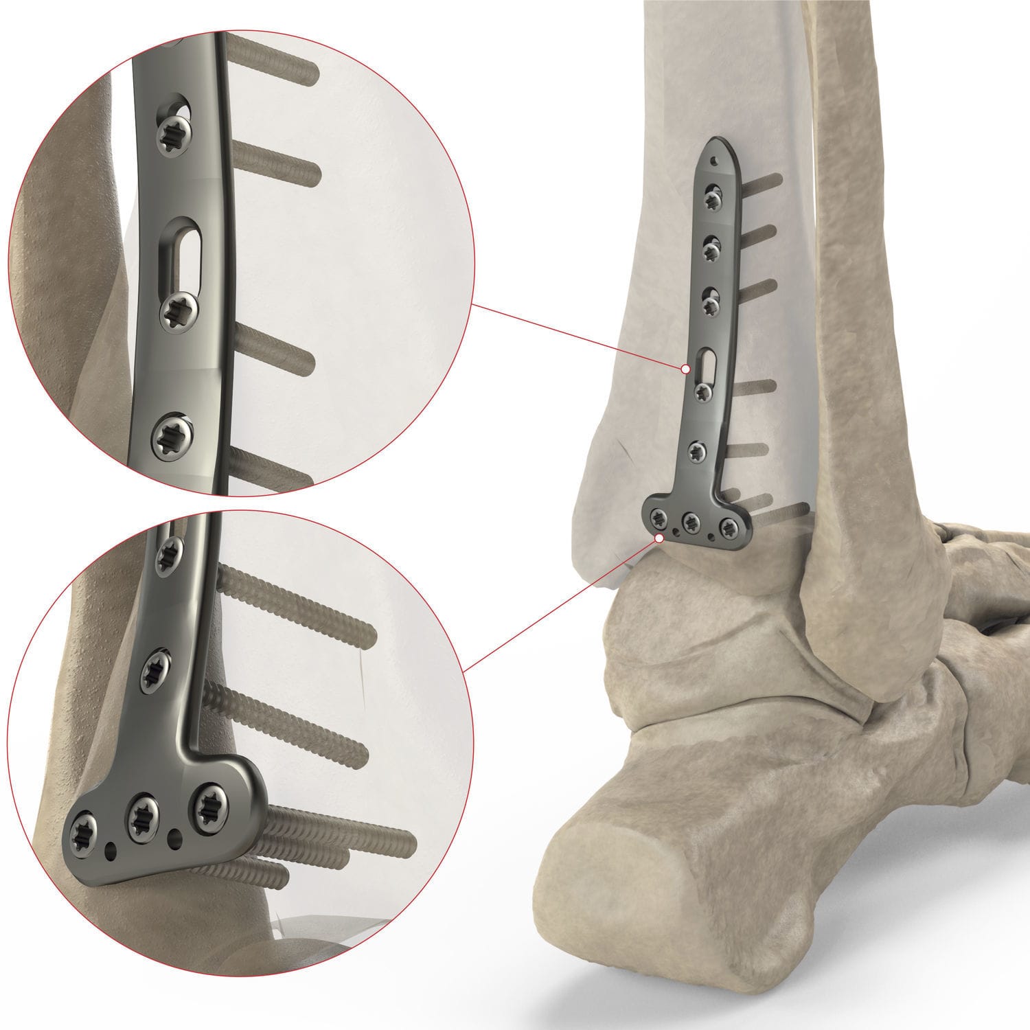 Plaque de compression de tibia - Ases Orthopedics - distale / verouillée