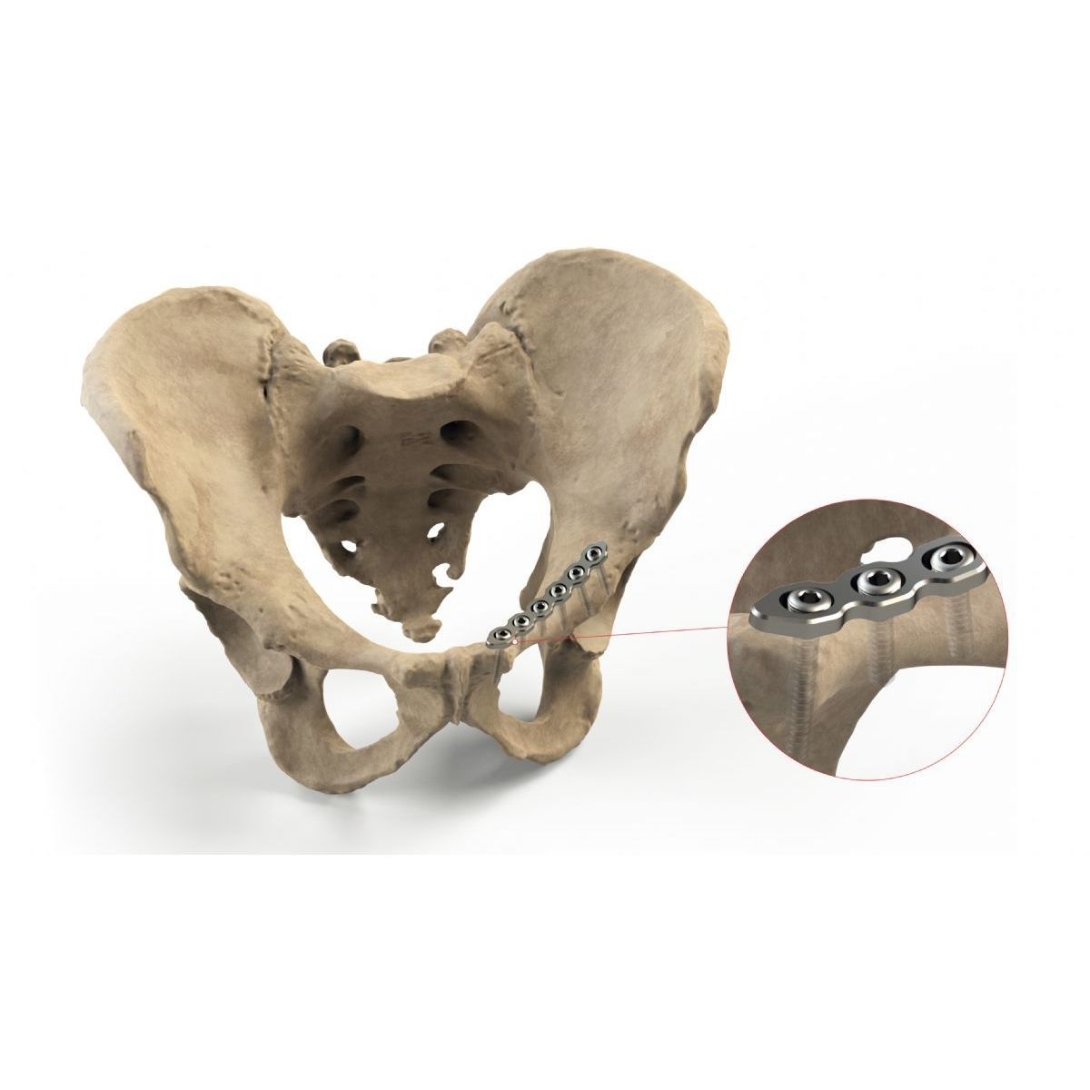 Plaque de compression de pelvis - Ases Orthopedics - verouillée