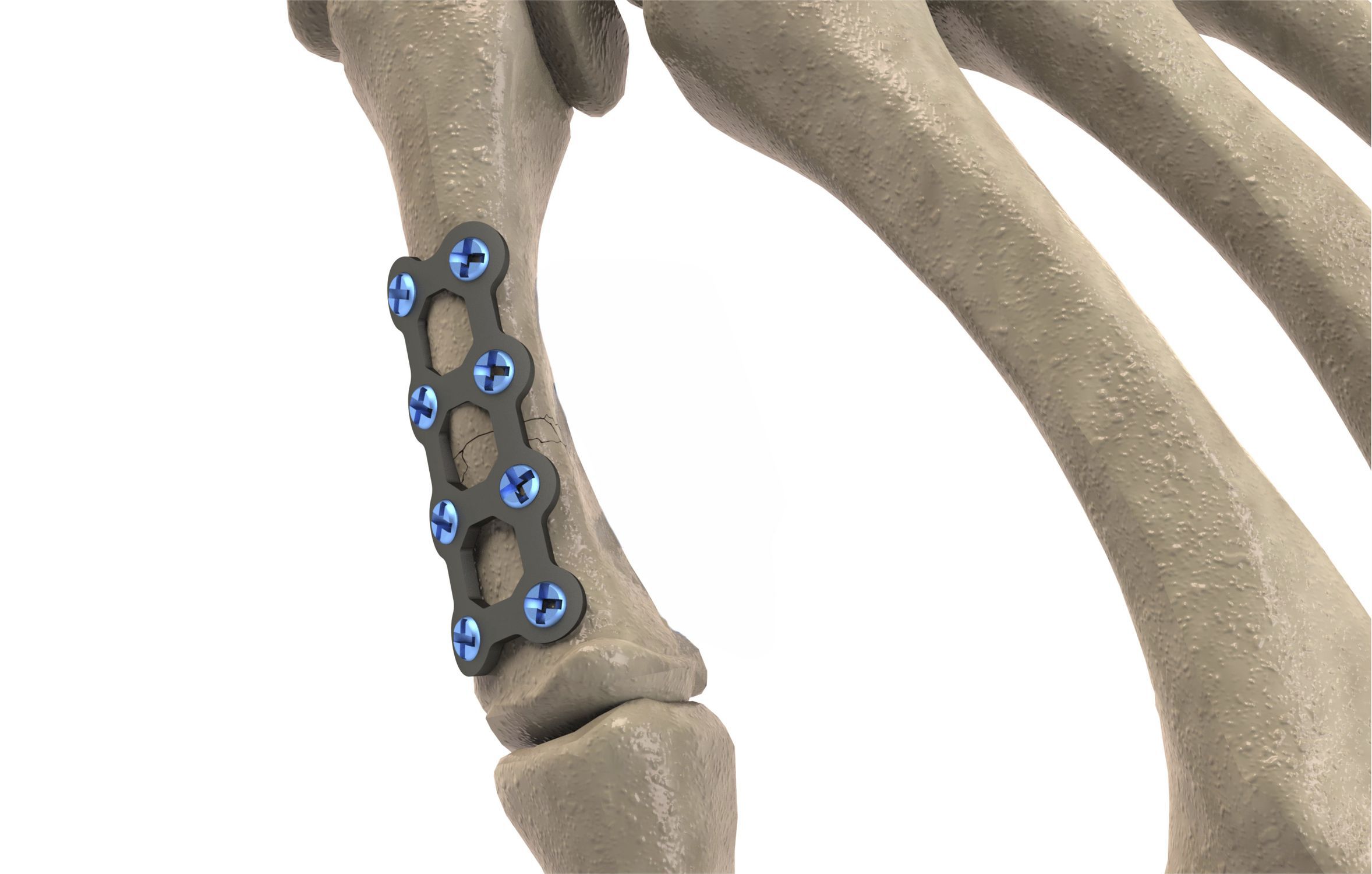 Plaque de compression de métacarpe - 1T112-10061506 - Ases Orthopedics ...