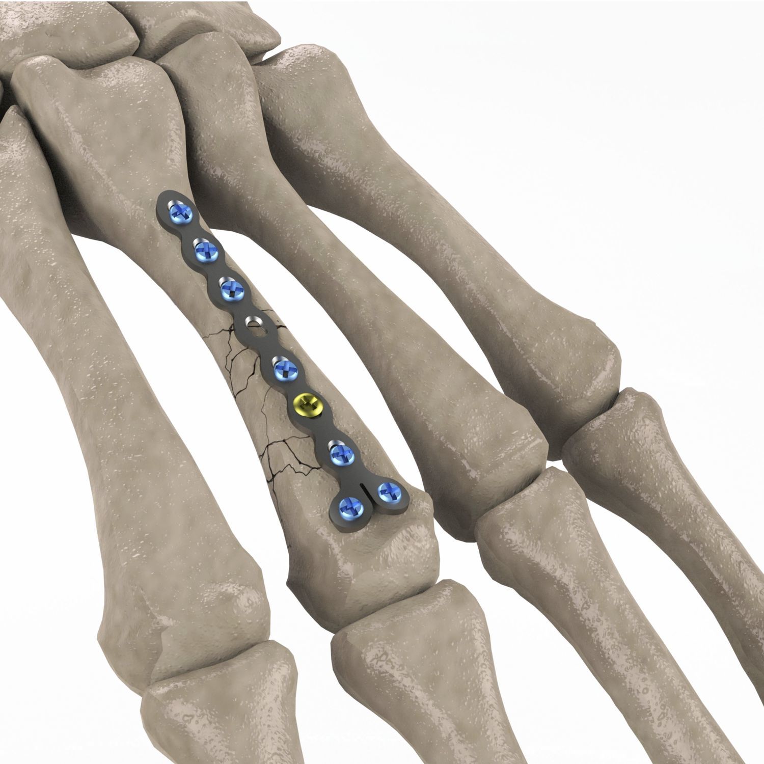 Plaque de compression de métacarpe - 1T112-100102023 - Ases Orthopedics ...