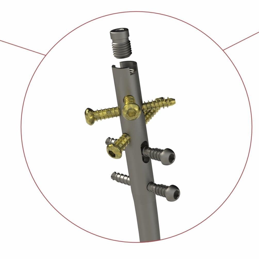 Clou intramédullaire de tibia - 4T1-4011000 - Ases Orthopedics