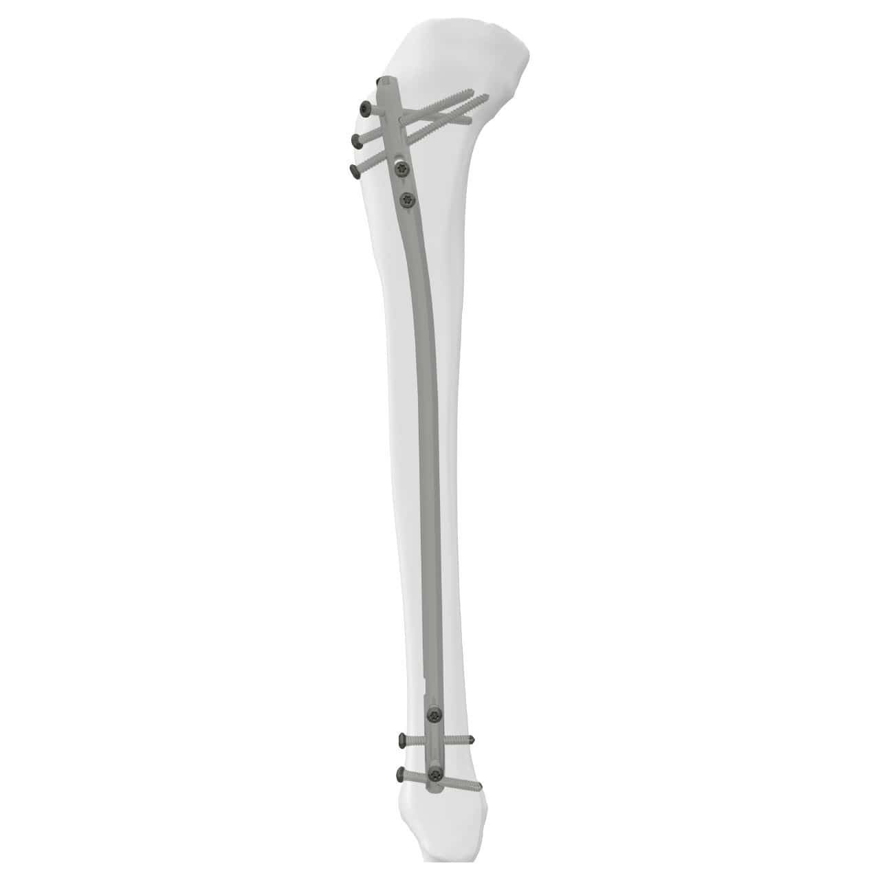 Clou intramédullaire de tibia - 305014 series - Boneunion Medical ...