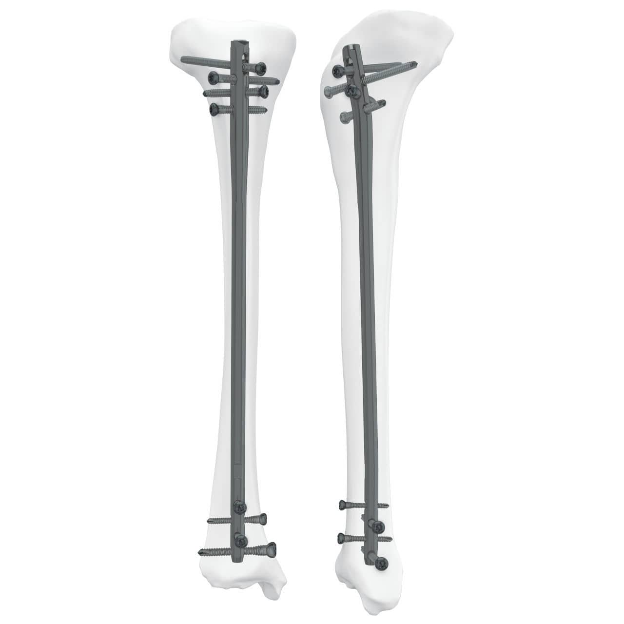 Clou intramédullaire de tibia - 305050 series - Boneunion Medical - fixation proximale ...
