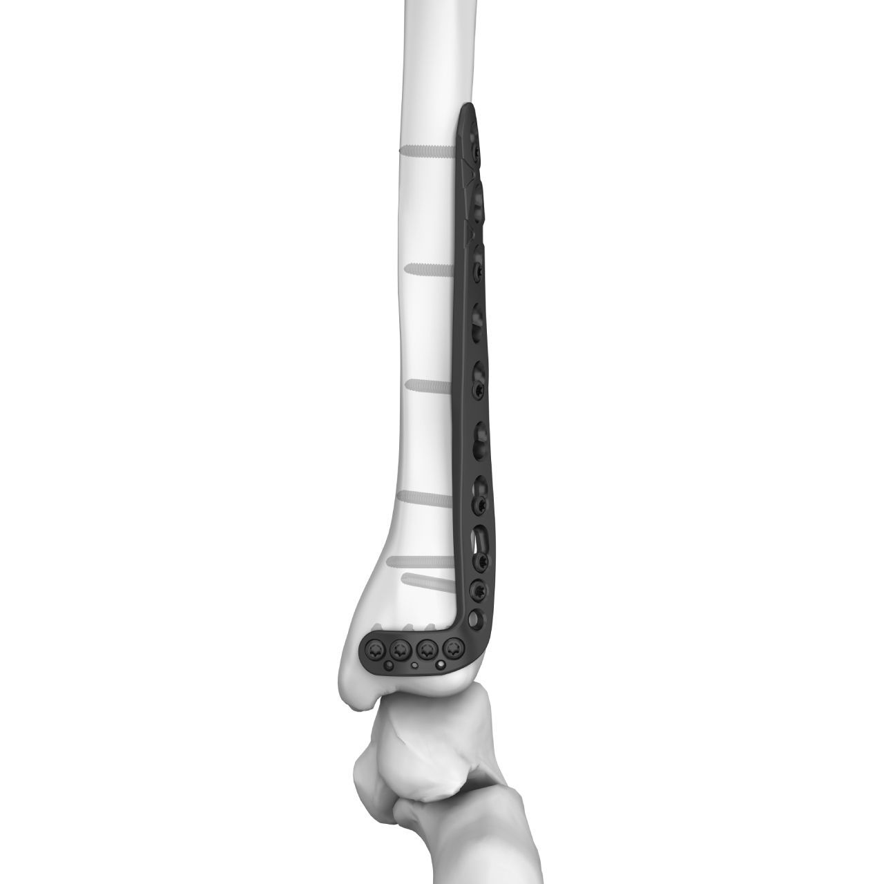 Plaque de compression de tibia - 301026 series - Boneunion Medical ...