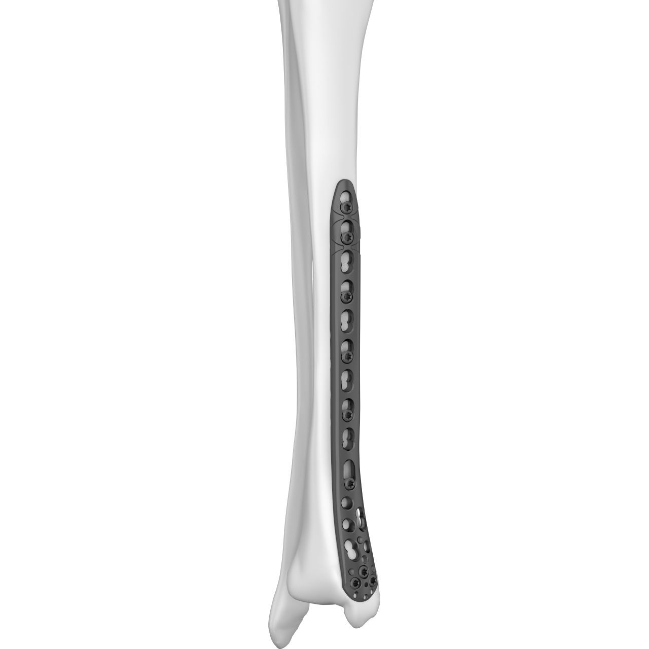 Plaque de compression de tibia - 301025 series - Boneunion Medical ...