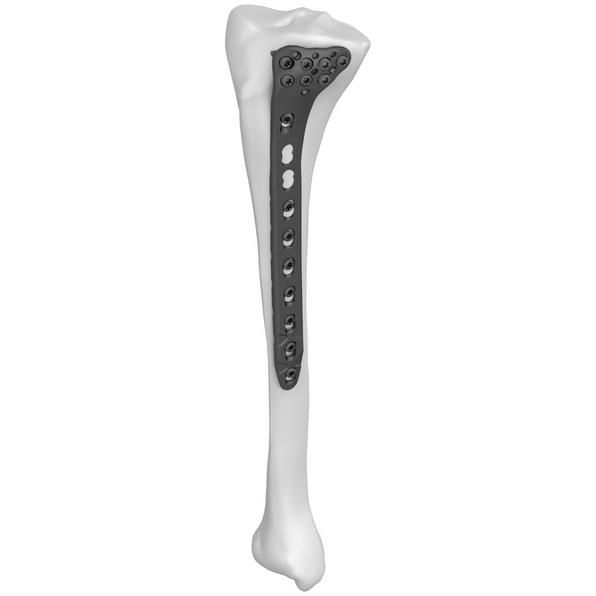 Plaque de compression de tibia - 301022 series - Boneunion Medical ...