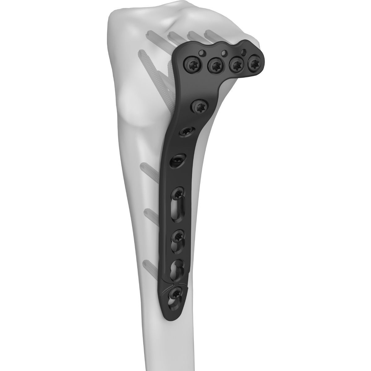 Plaque de compression de tibia - 301023 series - Boneunion Medical ...