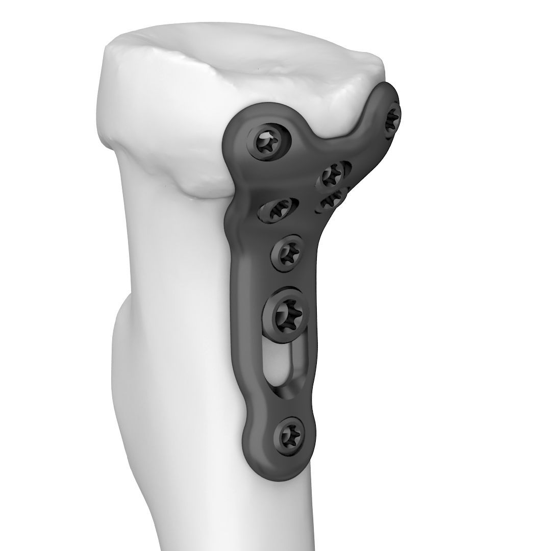 Plaque de compression de radius - 301178 series - Boneunion Medical ...