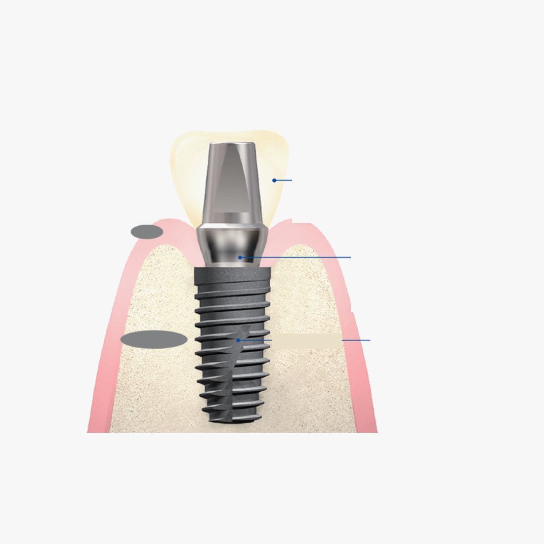 Pilier implantaire en titane - Snucone Co.,Ltd - en métal / interne / droit