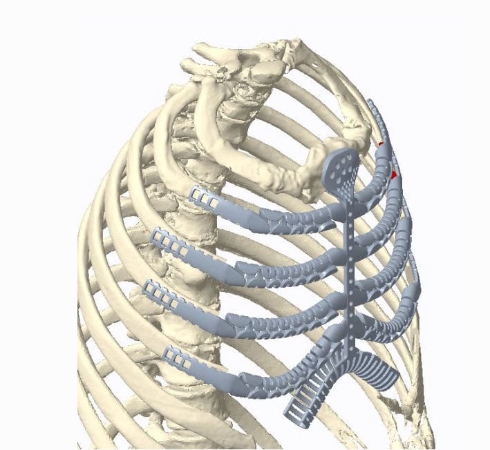 Prothèse costale pour reconstruction après resection des ostéosarcomes ...