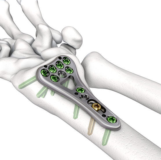 Plaque de compression de radius - LOQTEQ® VA 2.5 - aap Implantate ...