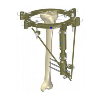 Fixateur externe de tibia - 549.10 - BAUMER - hybride